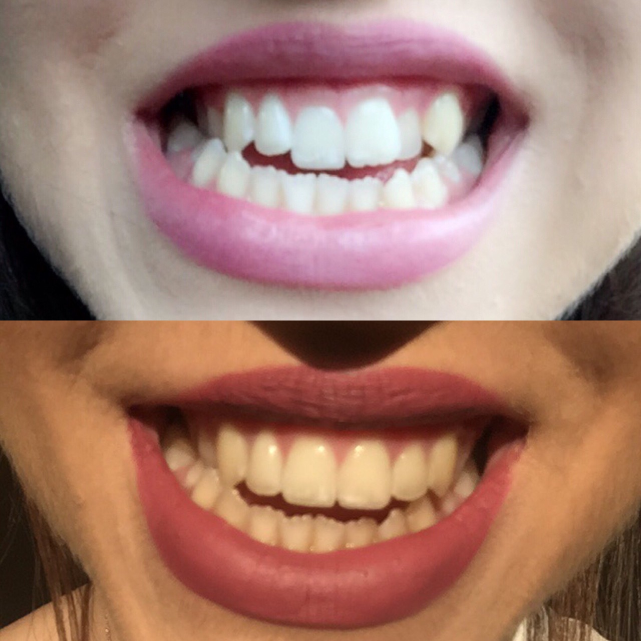 ‘I didn’t want to be 25 and have the metal “train tracks” again, so ...