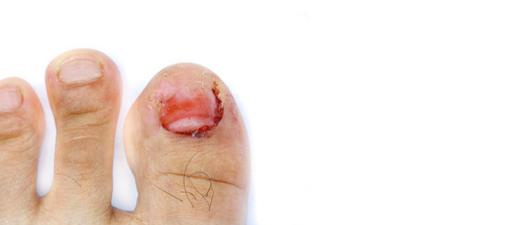 Fungal nail infection | Comparethetreatment.com