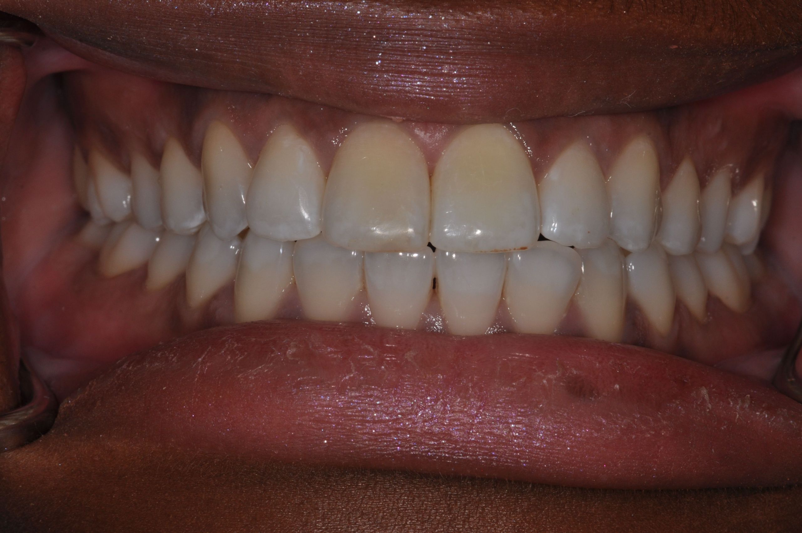 I recommended Cfast teeth-straightening braces to EVERYONE ...