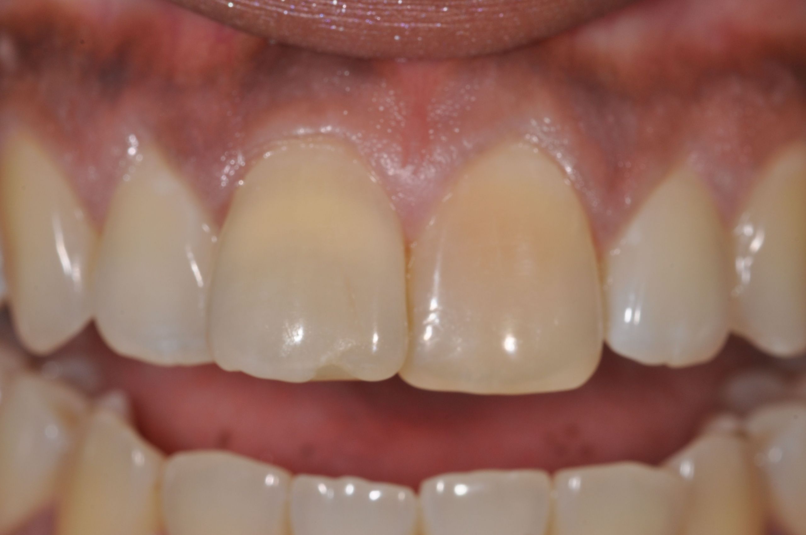 I recommended Cfast teeth-straightening braces to EVERYONE ...