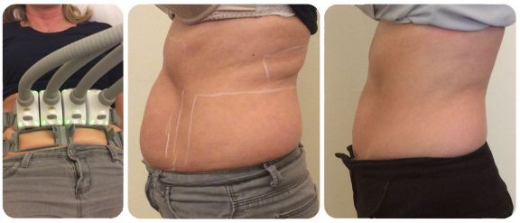 SculpSure Back & Abdominal Fat Reduction LaserSculpt Clinic ...