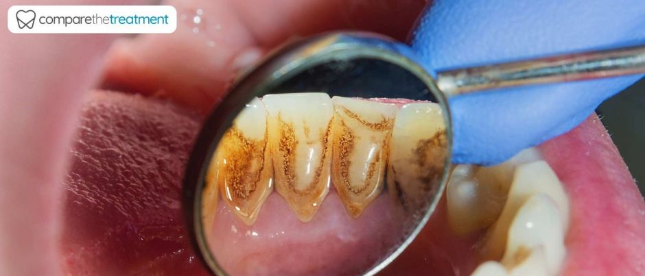 Two in three UK adults have visible plaque | Comparethetreatment.com